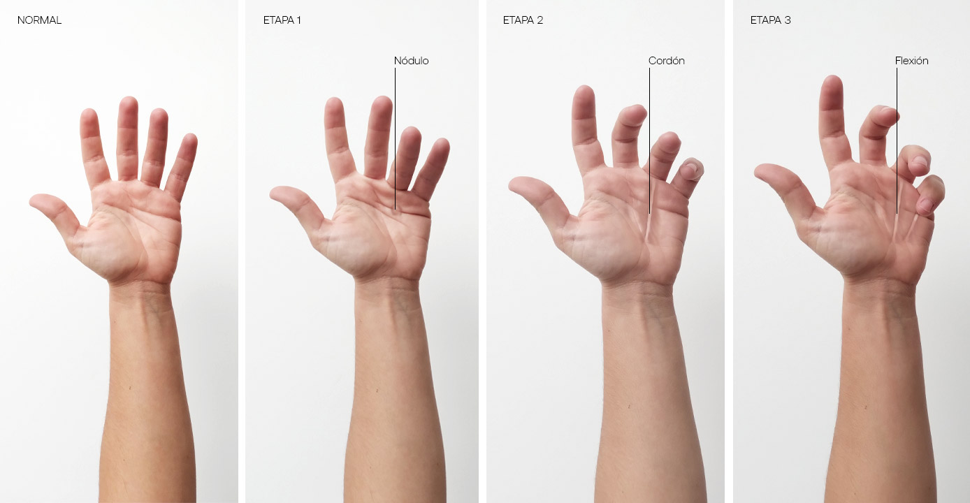 Ortesis para contractura de Dupuytren